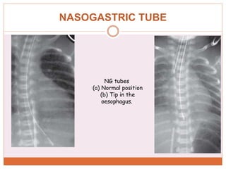 Pediatric chest xray | PPT