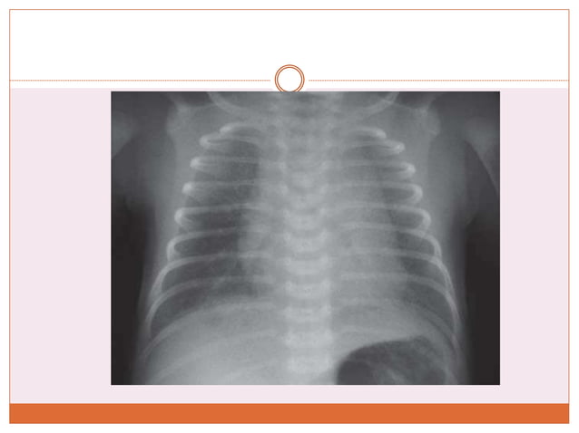 Pediatric chest xray | PPT | Lung and Respiratory Health | Diseases and ...