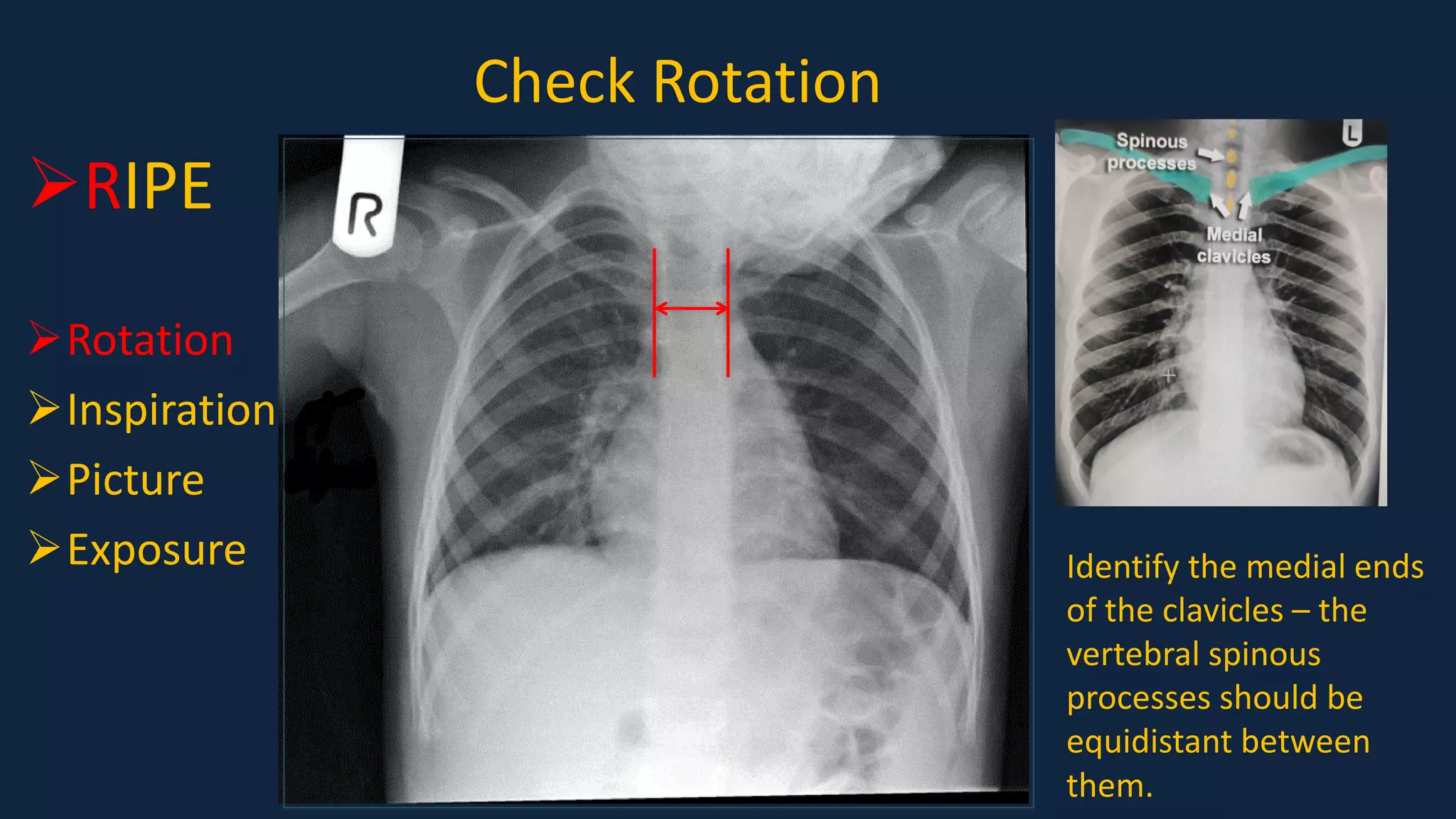 Pediatric Chest x ray Interpretation.pdf