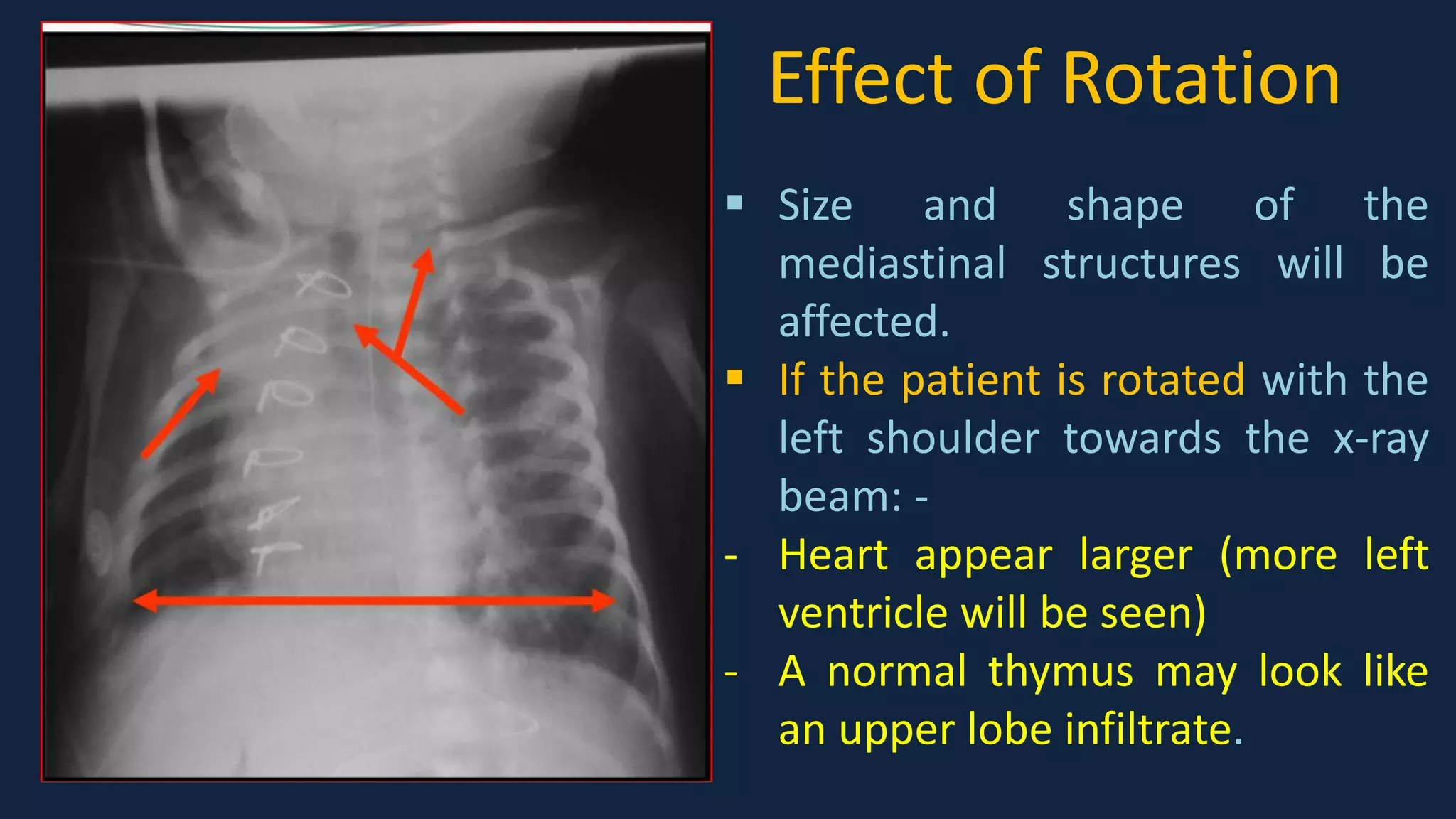 Pediatric Chest x ray Interpretation.pdf