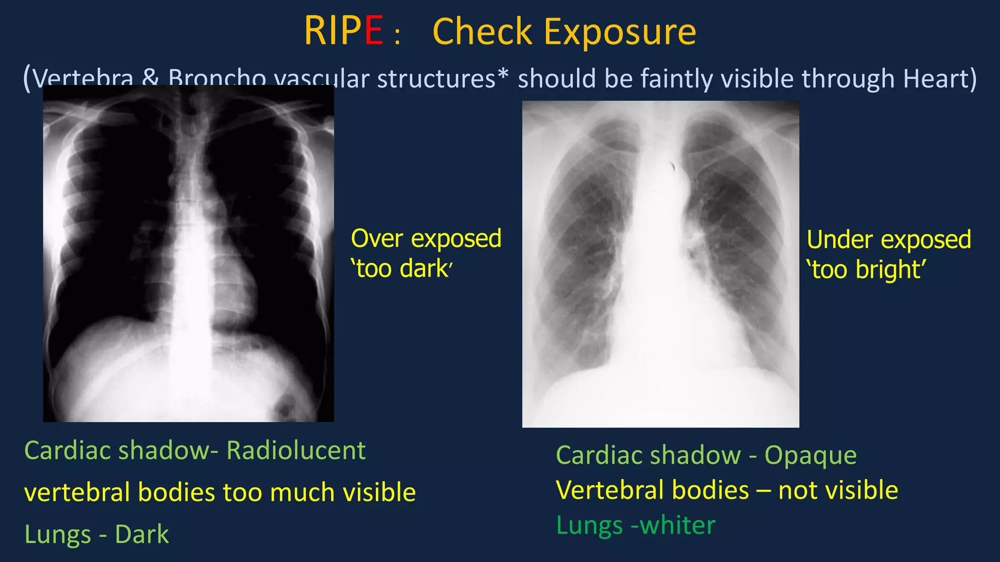Pediatric Chest x ray Interpretation.pdf