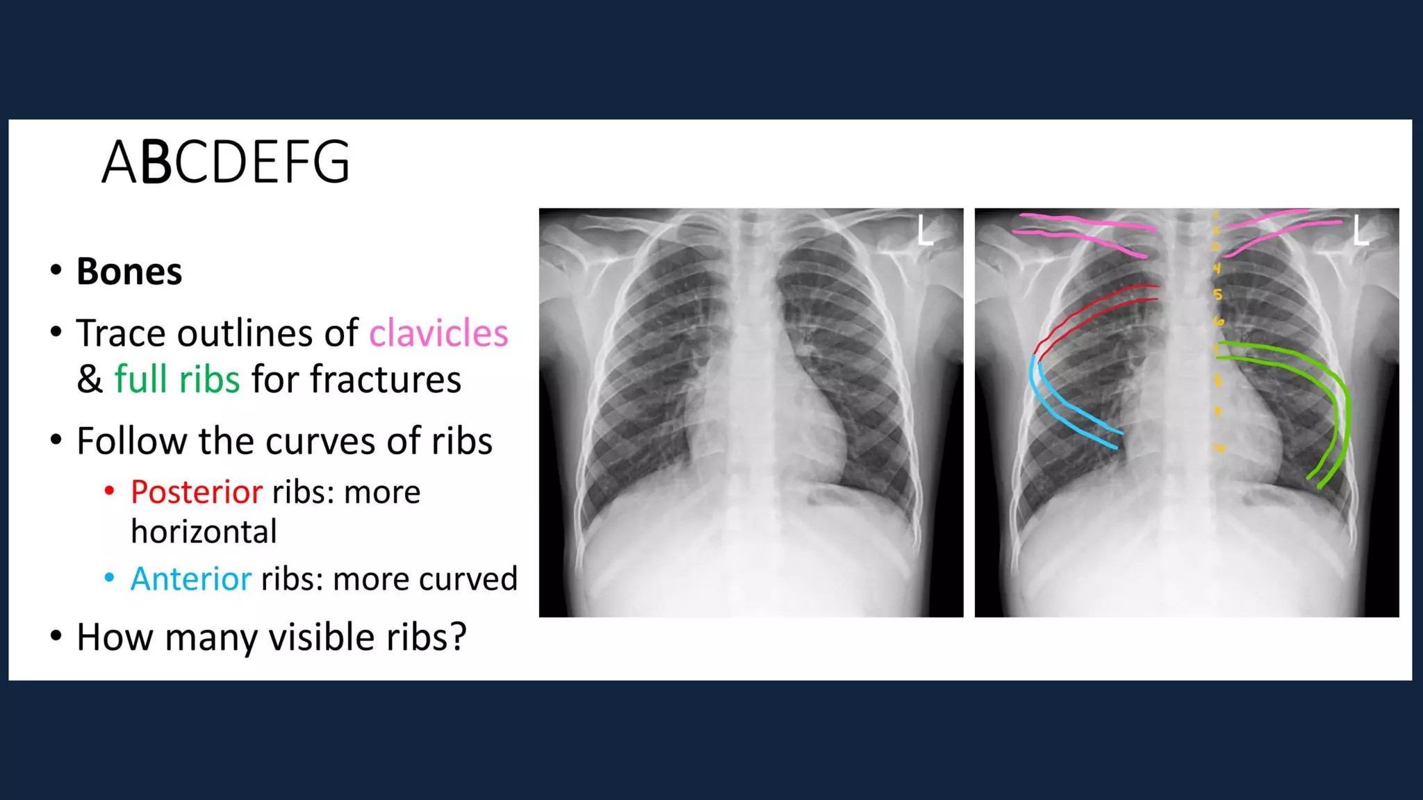 Pediatric Chest x ray Interpretation.pdf