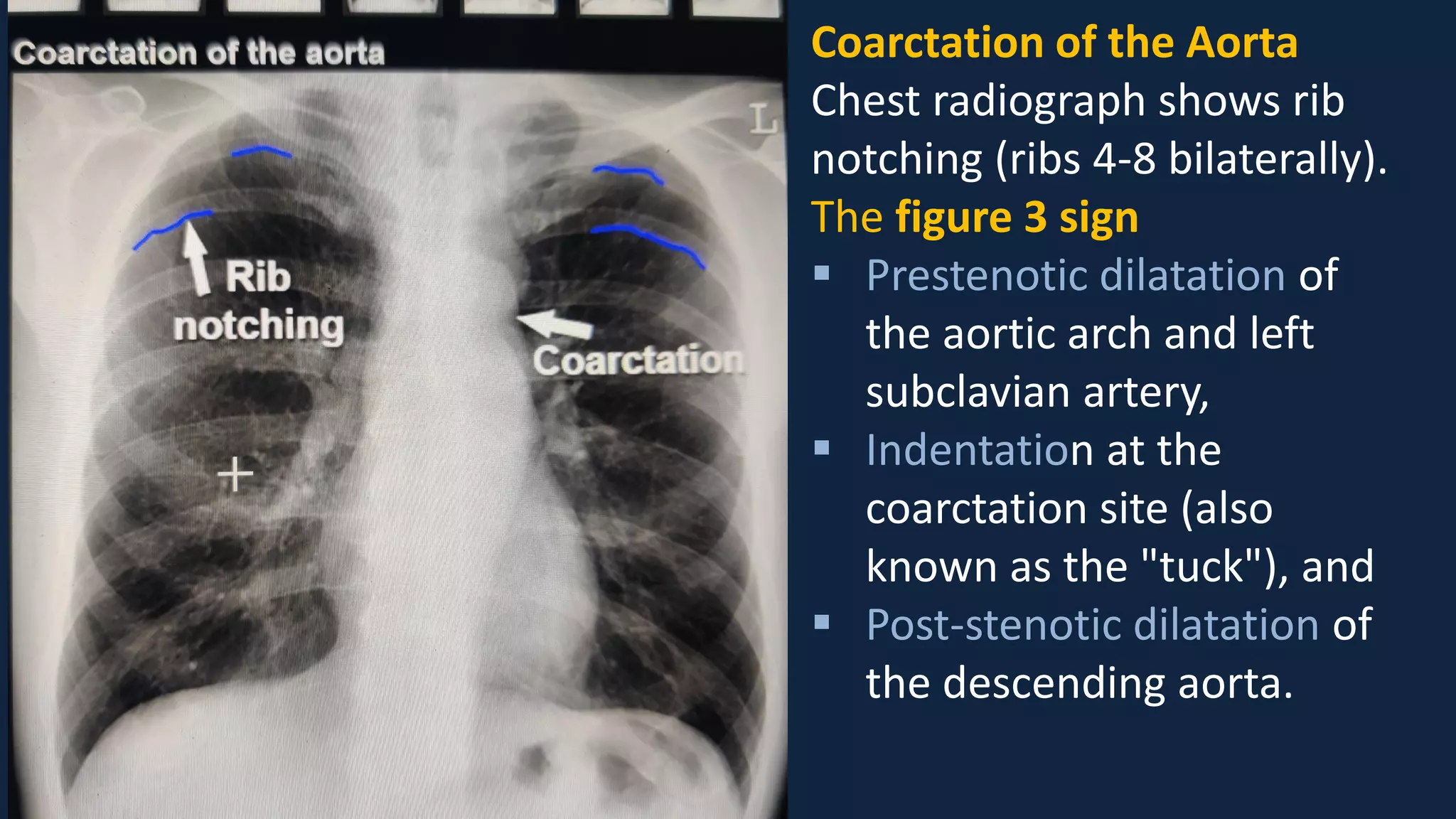 Pediatric Chest x ray Interpretation.pdf