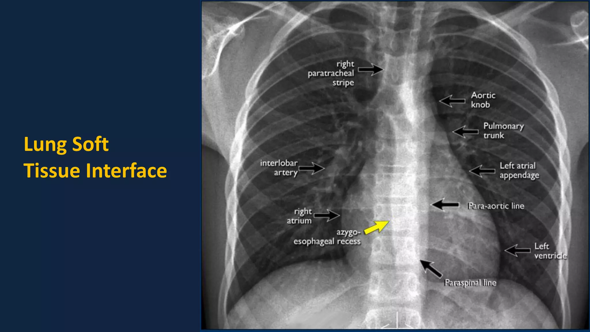 Pediatric Chest x ray Interpretation.pdf