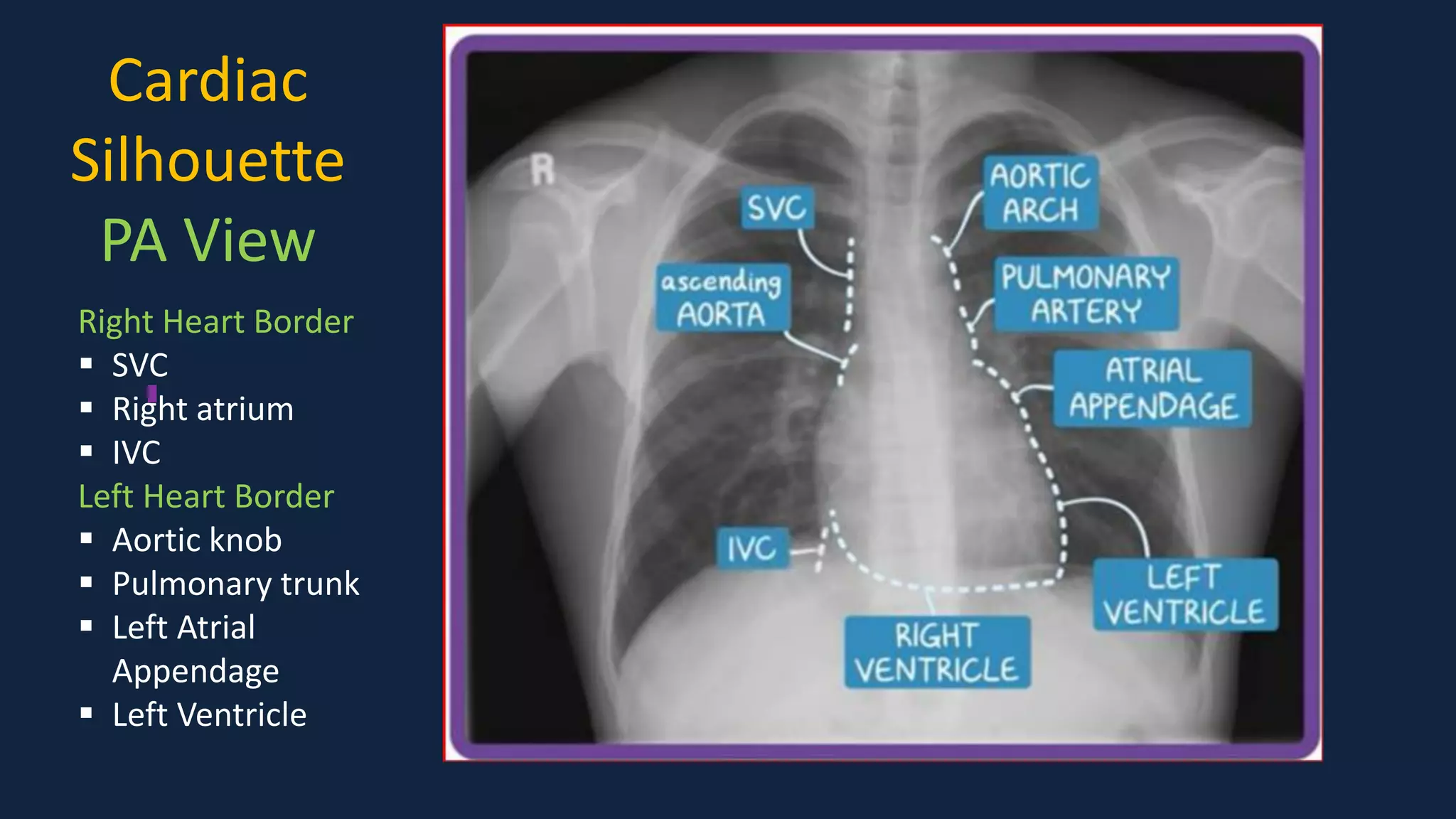 Pediatric Chest x ray Interpretation.pdf