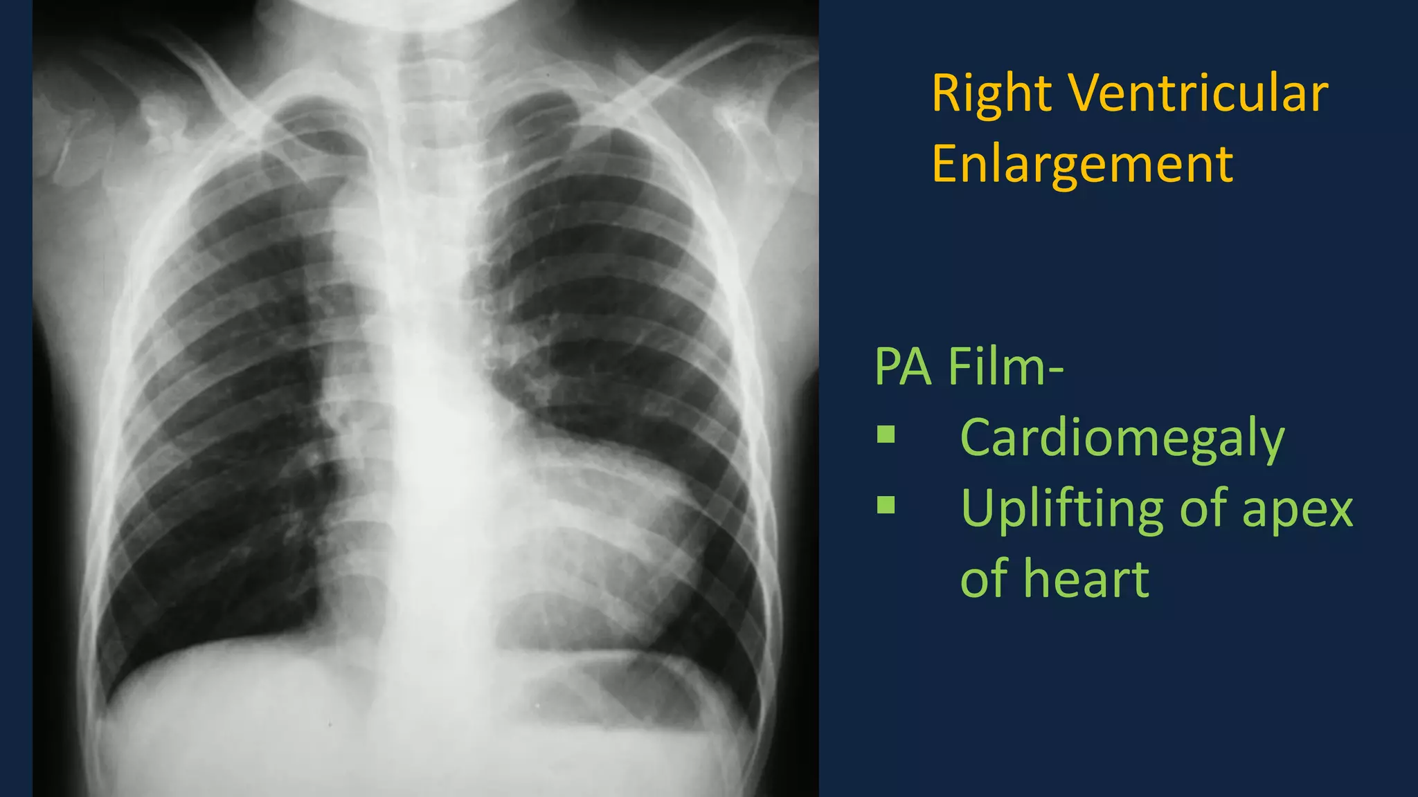 Pediatric Chest x ray Interpretation.pdf