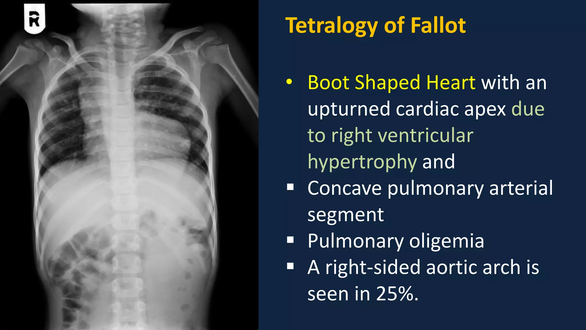 Pediatric Chest x ray Interpretation.pdf