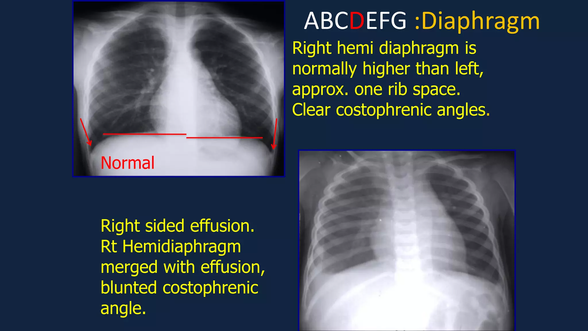 Pediatric Chest x ray Interpretation.pdf