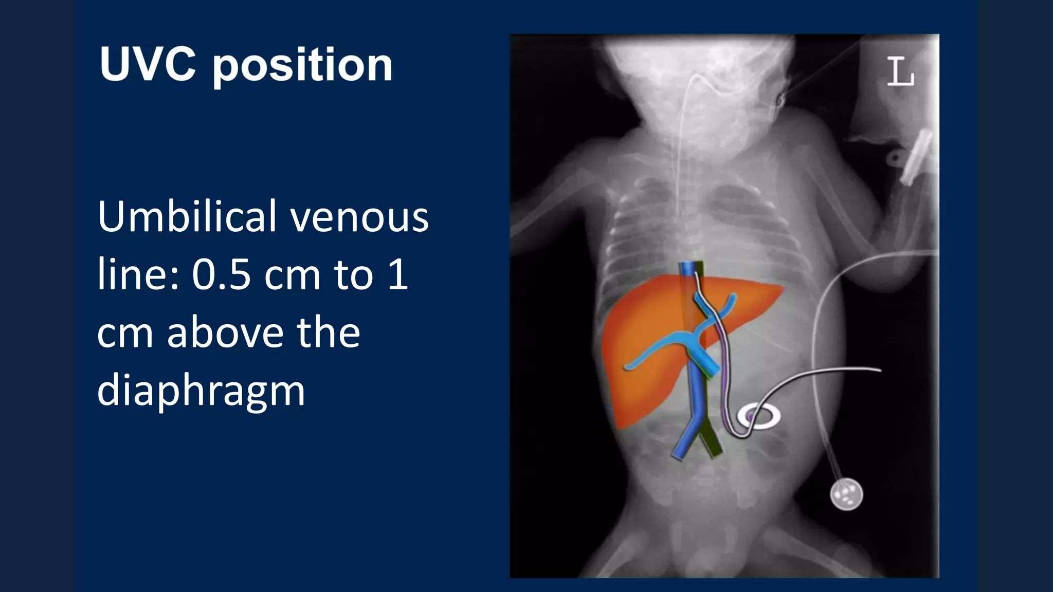 Pediatric Chest x ray Interpretation.pdf