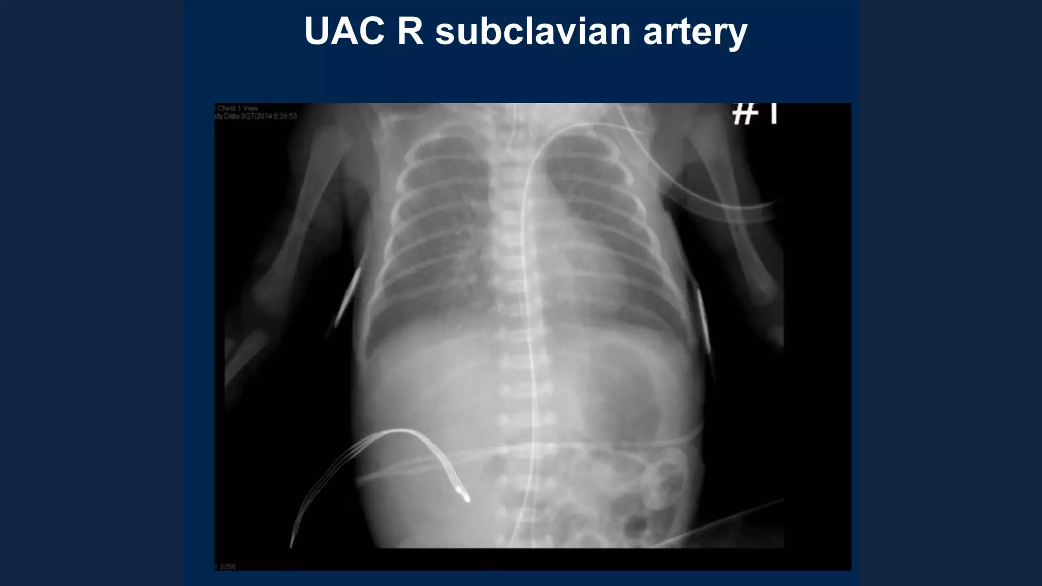 Pediatric Chest x ray Interpretation.pdf