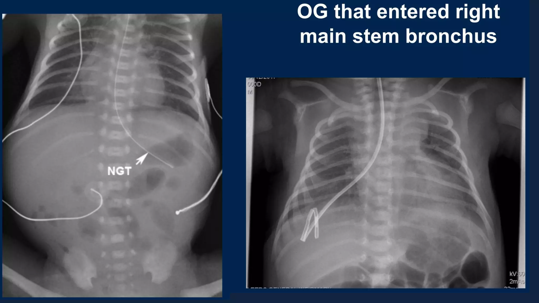 Pediatric Chest x ray Interpretation.pdf