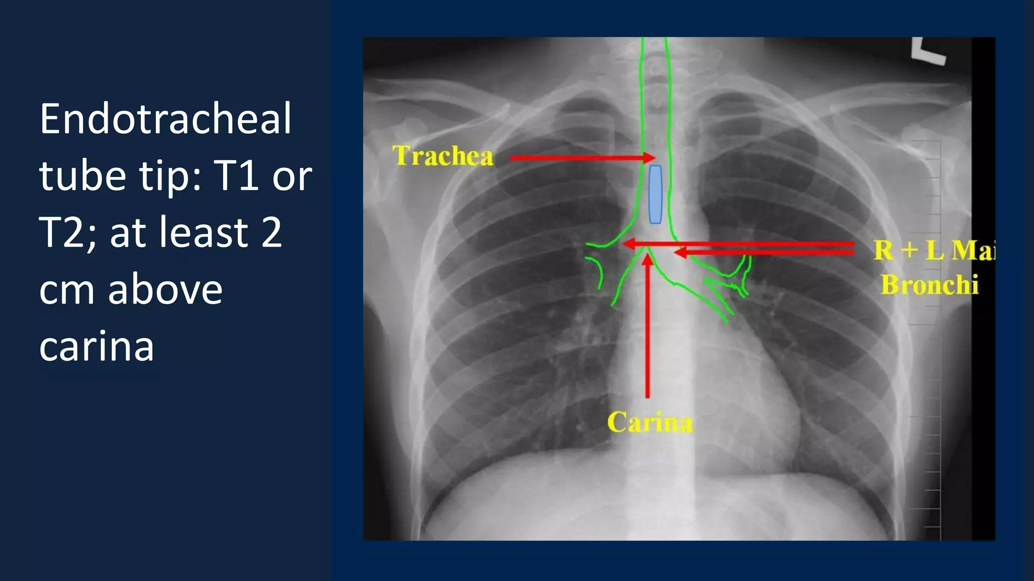 Pediatric Chest x ray Interpretation.pdf
