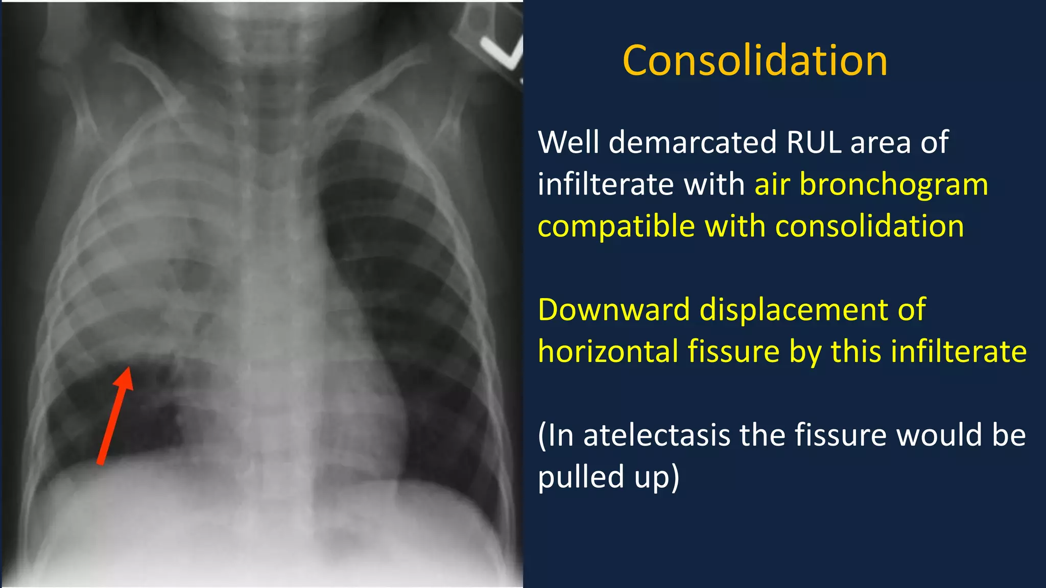 Pediatric Chest x ray Interpretation.pdf