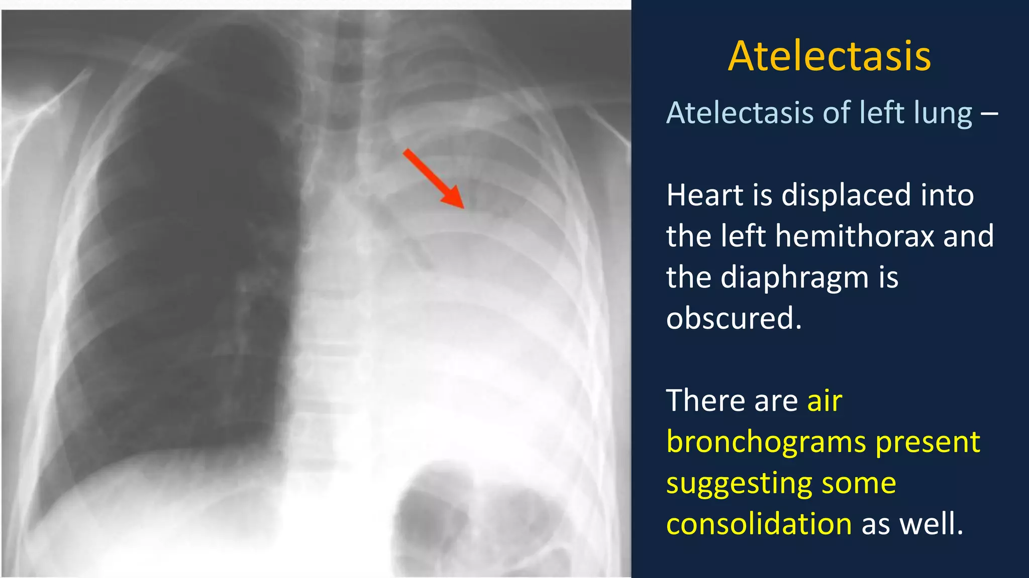 Pediatric Chest x ray Interpretation.pdf