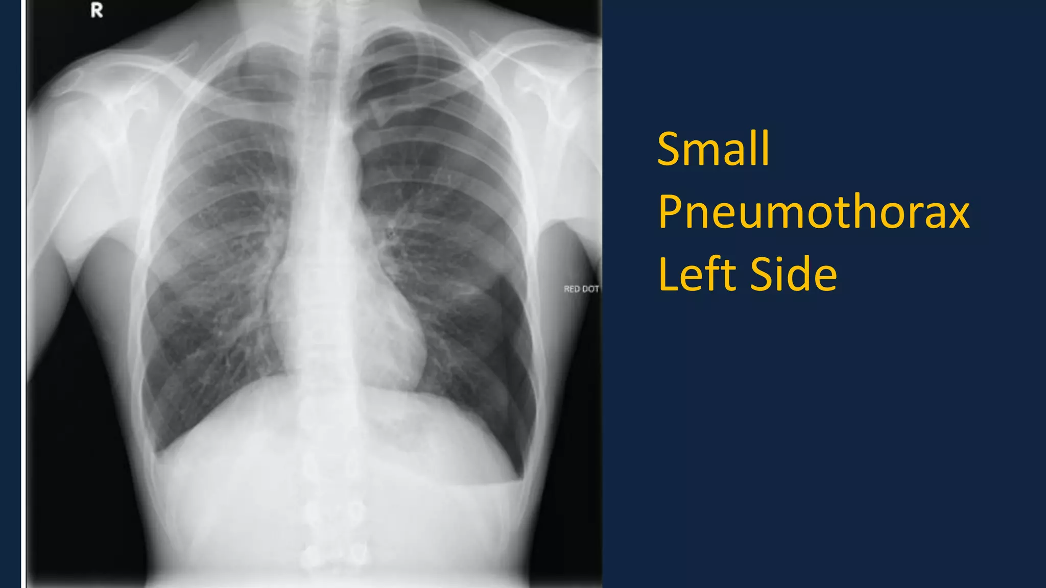 Pediatric Chest x ray Interpretation.pdf
