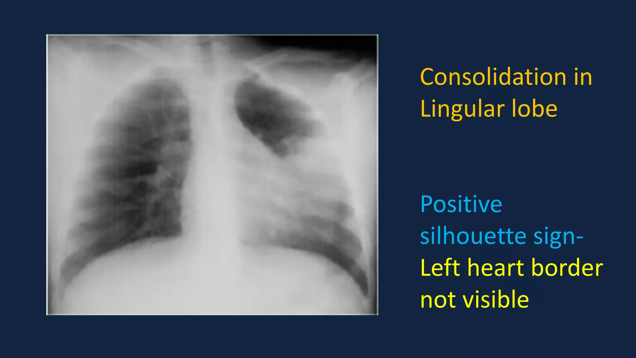 Pediatric Chest x ray Interpretation.pdf