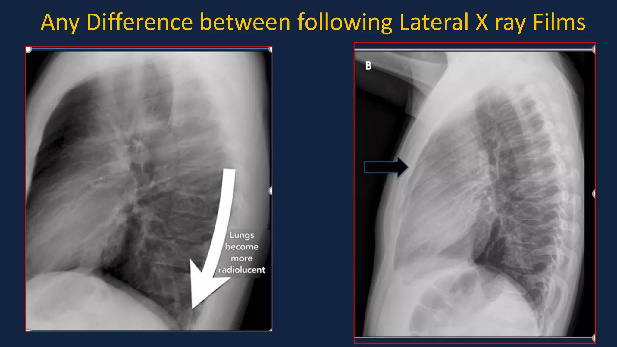 Pediatric Chest x ray Interpretation.pdf