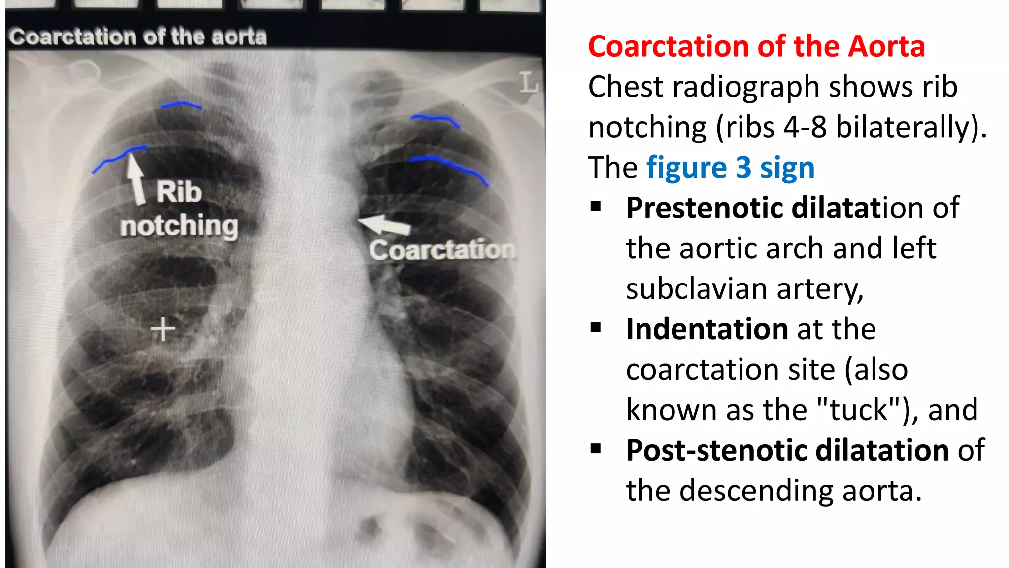 Pediatric Chest x ray Interpretation.pdf