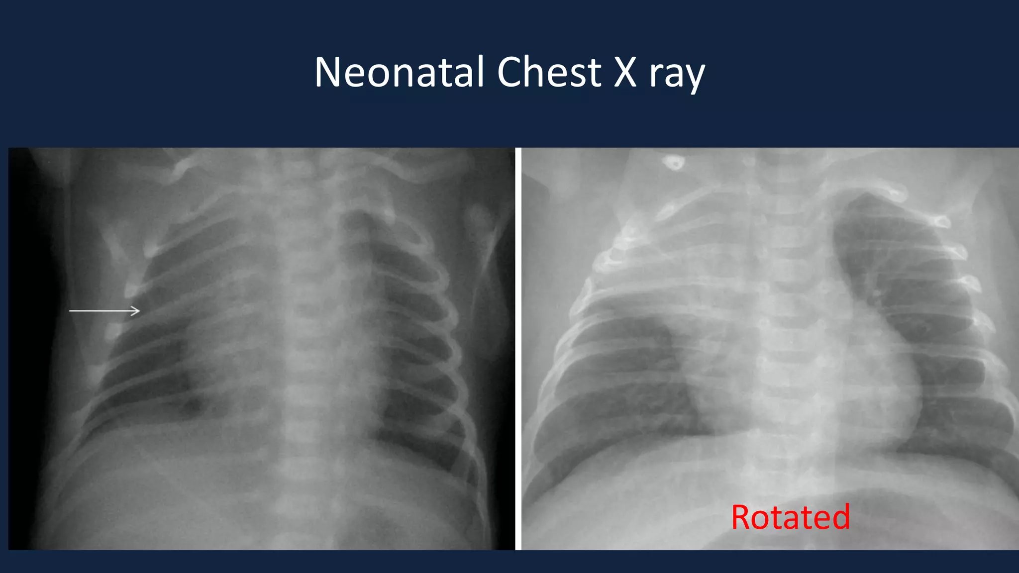 Pediatric Chest x ray Interpretation.pdf