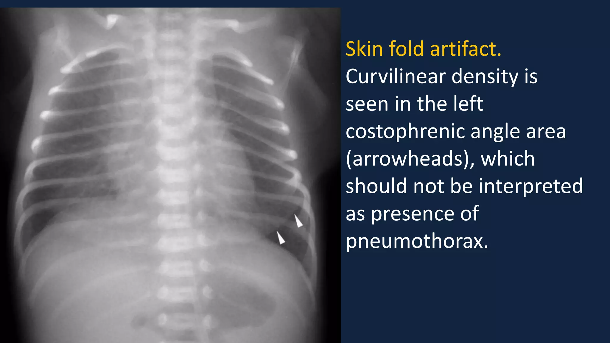 Pediatric Chest x ray Interpretation.pdf