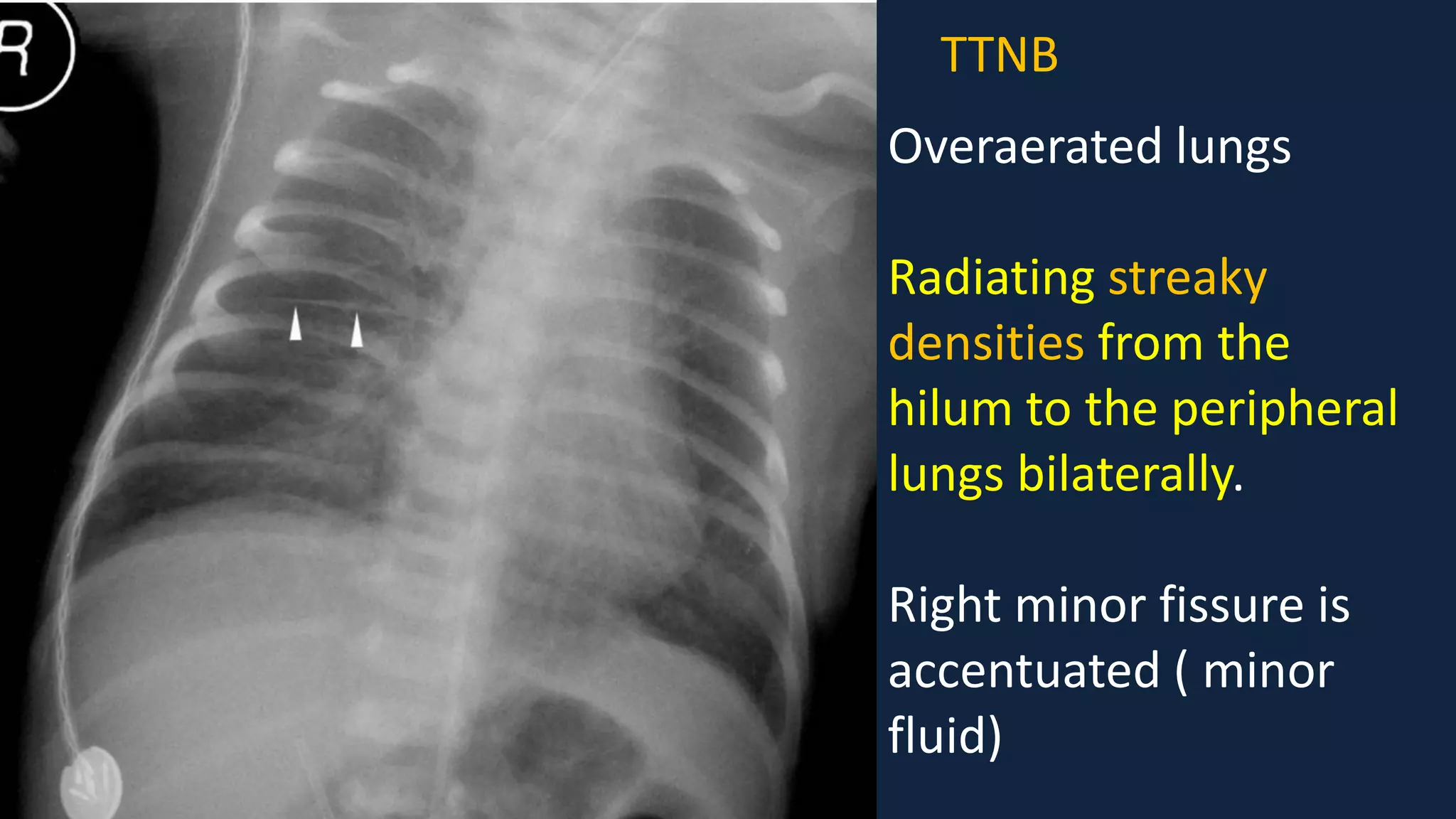 Pediatric Chest x ray Interpretation.pdf