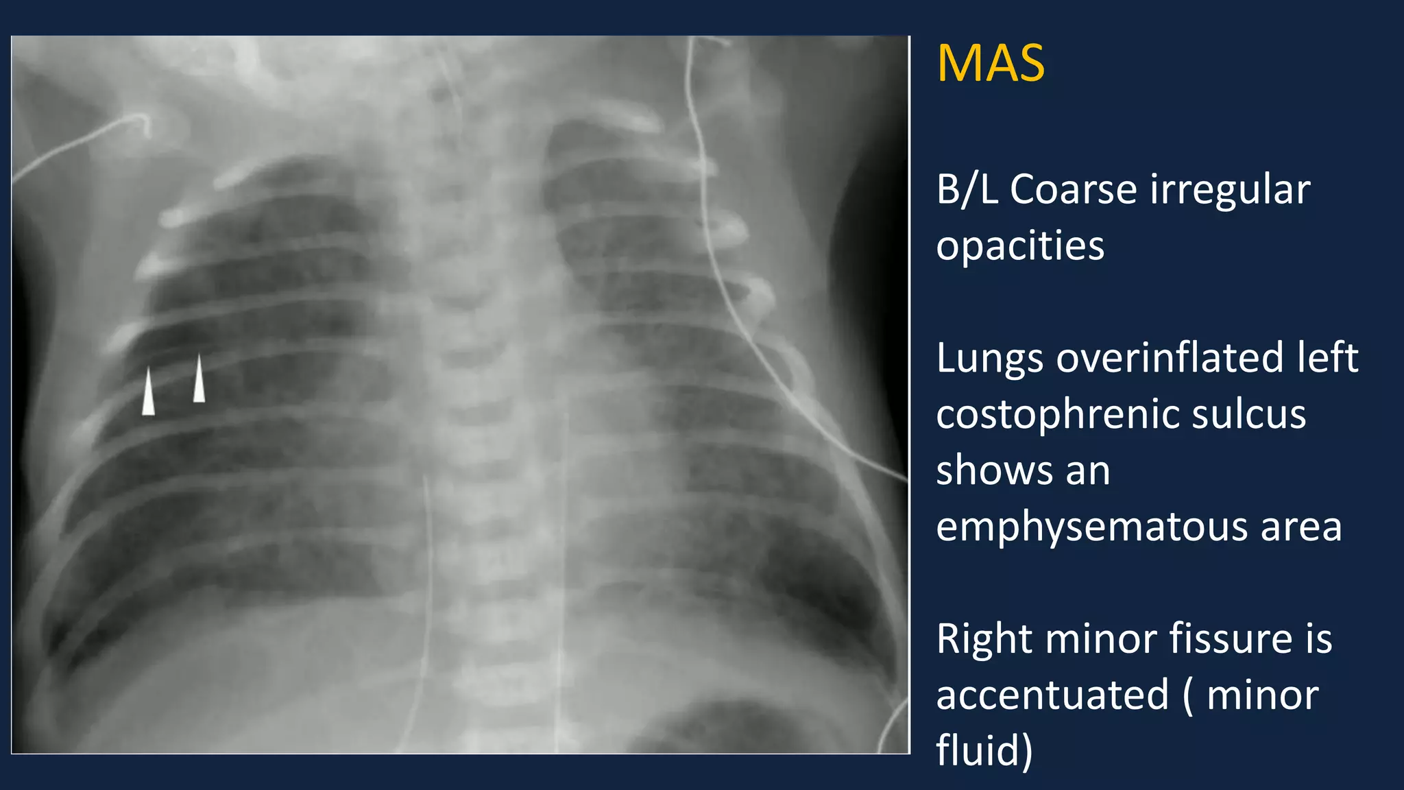 Pediatric Chest x ray Interpretation.pdf