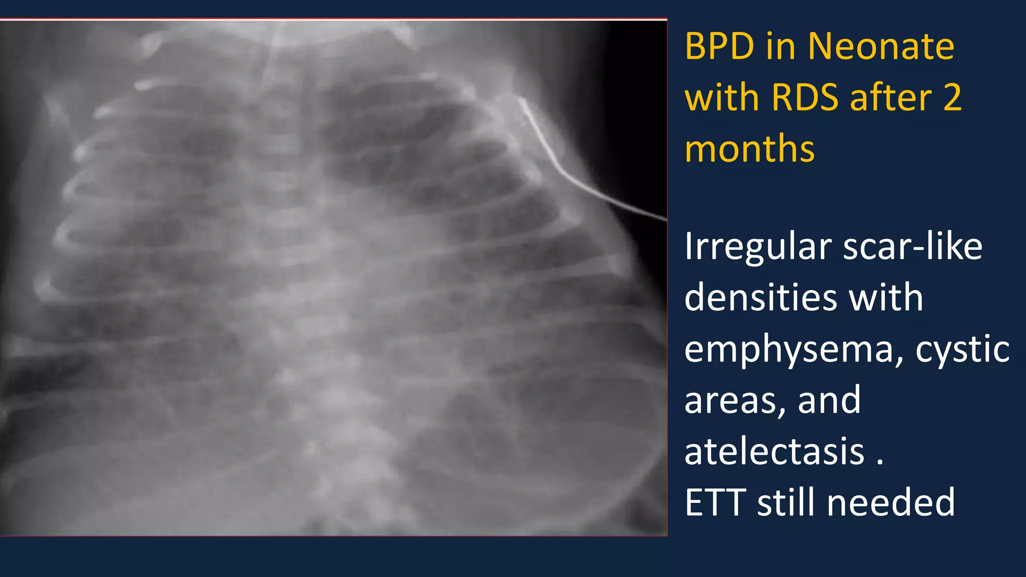 Pediatric Chest x ray Interpretation.pdf