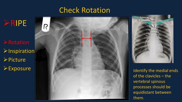Pediatric Chest x ray Interpretation.pdf