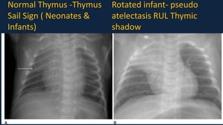 Pediatric Chest x ray Interpretation.pdf