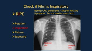 Pediatric Chest x ray Interpretation.pdf