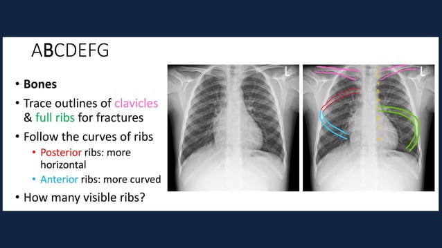 Pediatric Chest x ray Interpretation.pdf