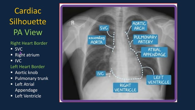 Pediatric Chest x ray Interpretation.pdf