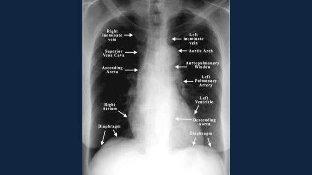 Pediatric Chest x ray Interpretation.pdf
