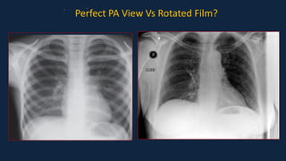 Pediatric Chest x ray Interpretation.pdf