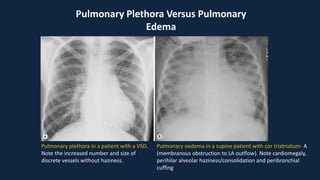 Pediatric Chest x ray Interpretation.pdf