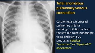 Pediatric Chest x ray Interpretation.pdf