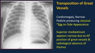 Pediatric Chest x ray Interpretation.pdf