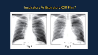 Pediatric Chest x ray Interpretation.pdf