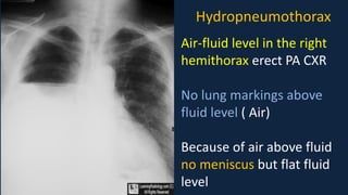 Pediatric Chest x ray Interpretation.pdf
