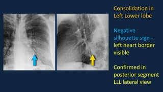 Pediatric Chest x ray Interpretation.pdf