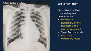 Pediatric Chest x ray Interpretation.pdf