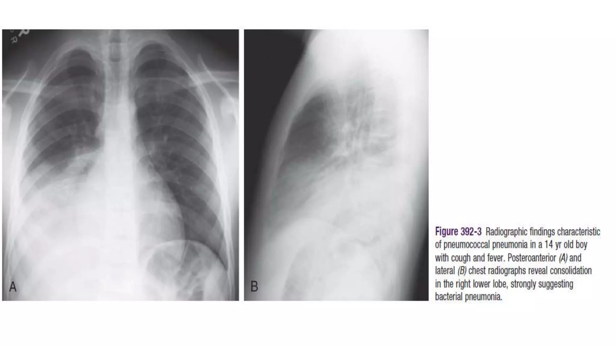Pediatric community Acquired Pneumonia | PPTX