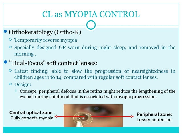 Pediatric contact lens | PPT