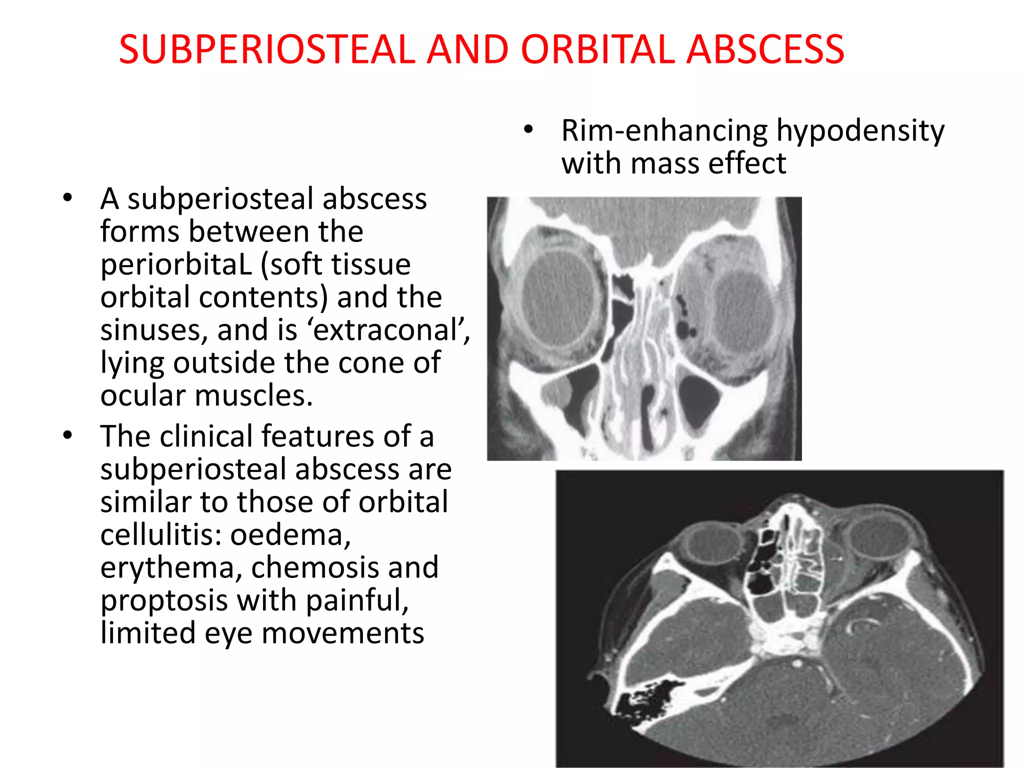 Pediatric crs complications final | PPTX