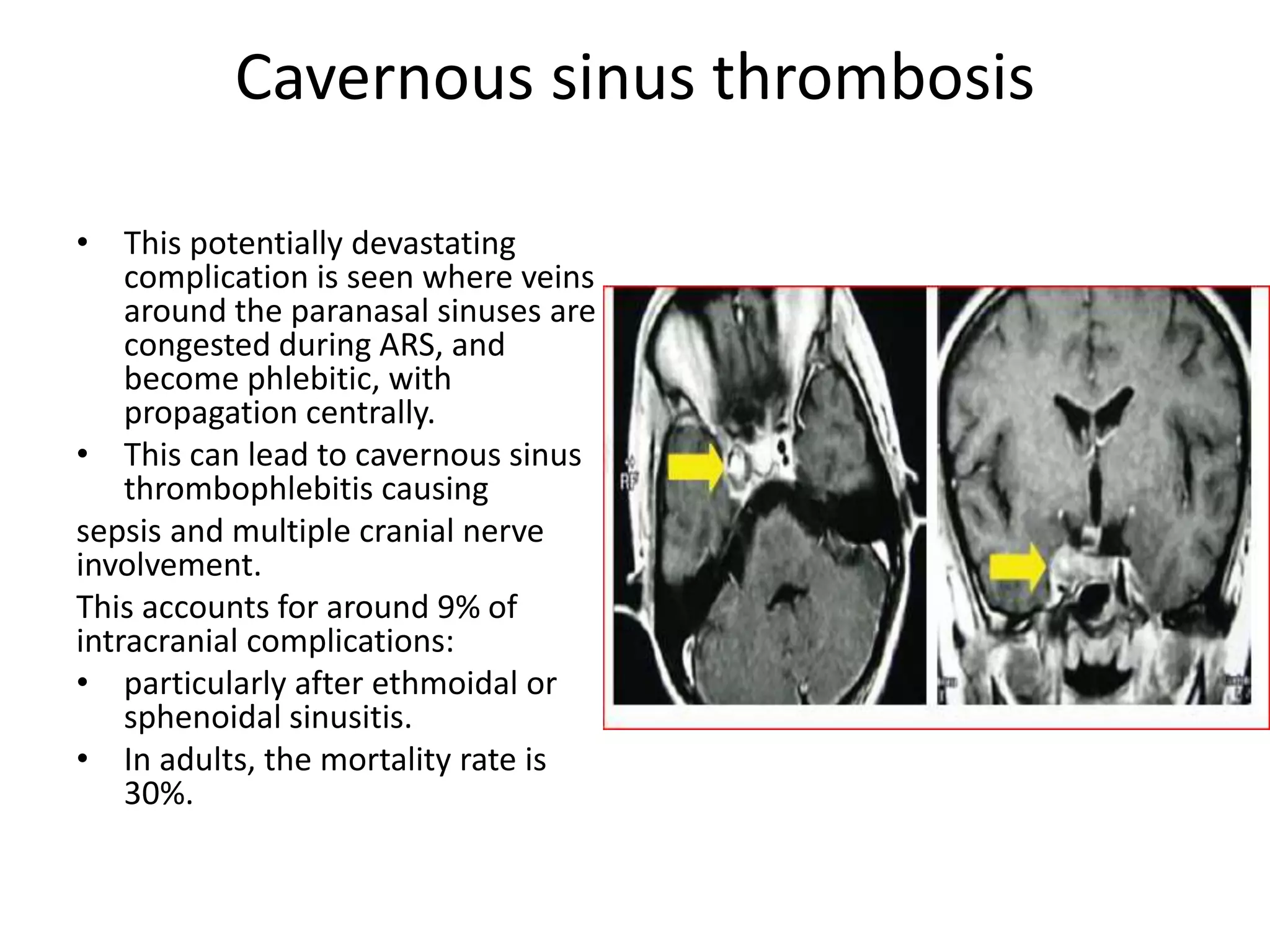 Pediatric crs complications final | PPTX