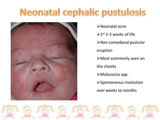 Neonatal Cephalic Pustulosis