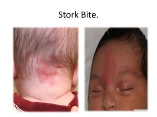 Stork Bite Back Of Neck