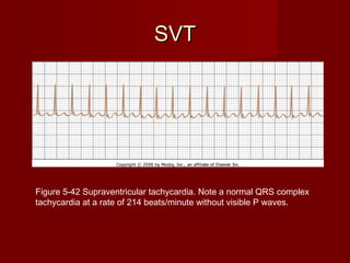 Pediatric dysrhythmias | PPT
