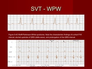 Pediatric dysrhythmias | PPT