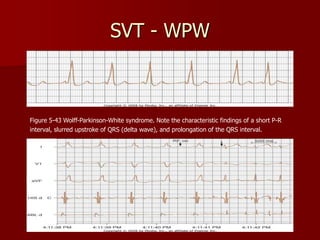 Pediatric Dysrhythmias.ppt